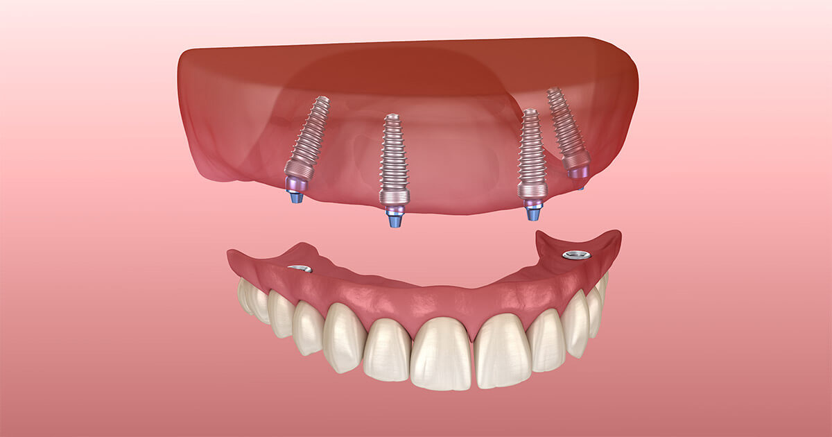 Unsere zeit- und kostensparende Zahnersatz-Methode!